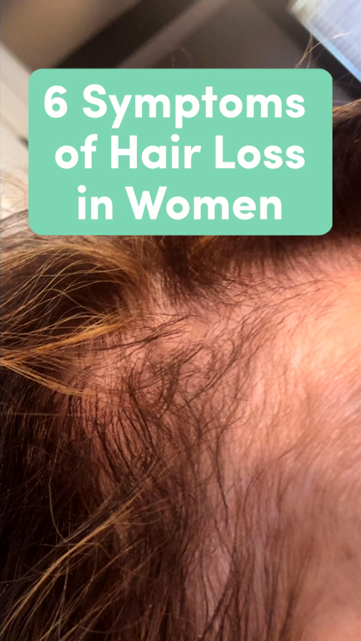 Male Pattern Baldness In Women Pcos